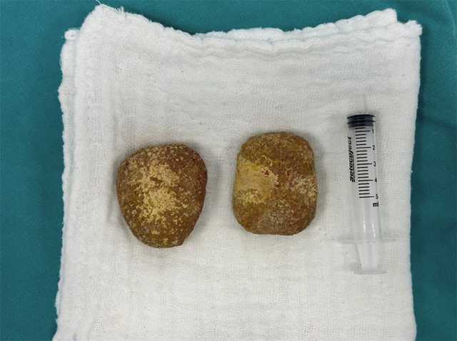 Hastanın mesanesinden 11 santim büyüklüğünde taş çıkarıldı